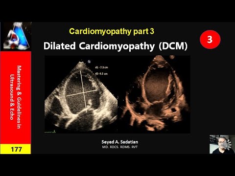 Dilated Cardiomyopathy Echo