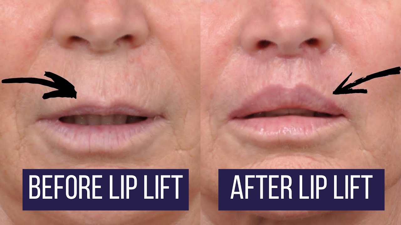 Los Angeles Upper Lip Lift | Beverly Hills Lip Augmentation Plastic ...