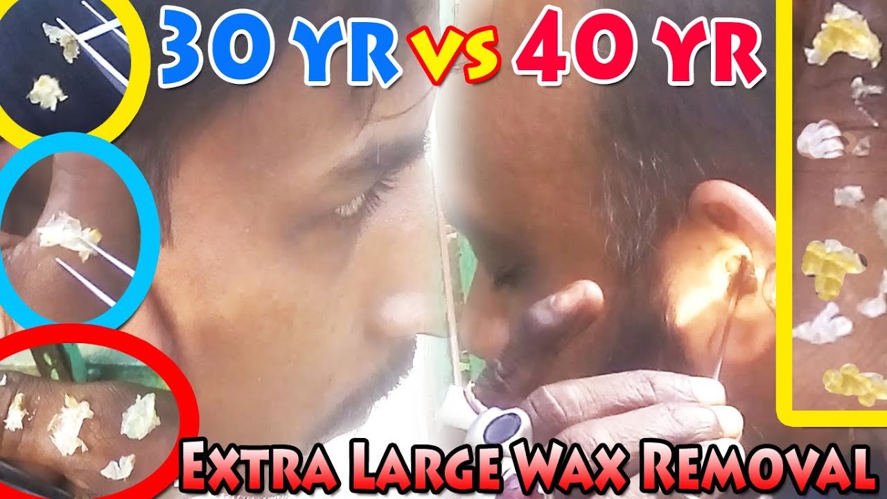 [Ton's] of Blocked White Earwax & Dirt Removal from 2 Guys/ Most ...