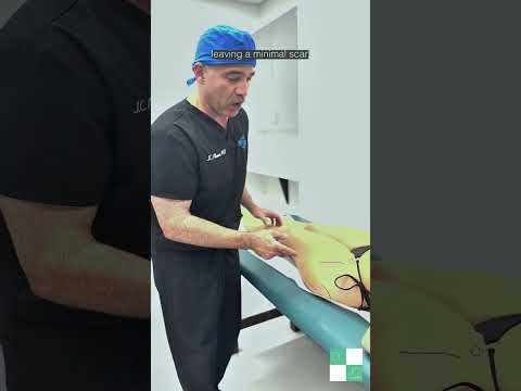 This is how bikini hip replacement works