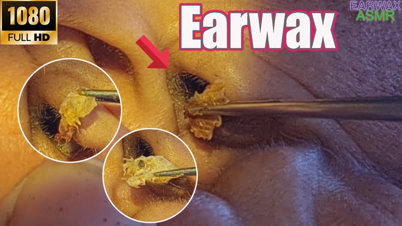earwax and dead skin. Get it out completed - YouTube