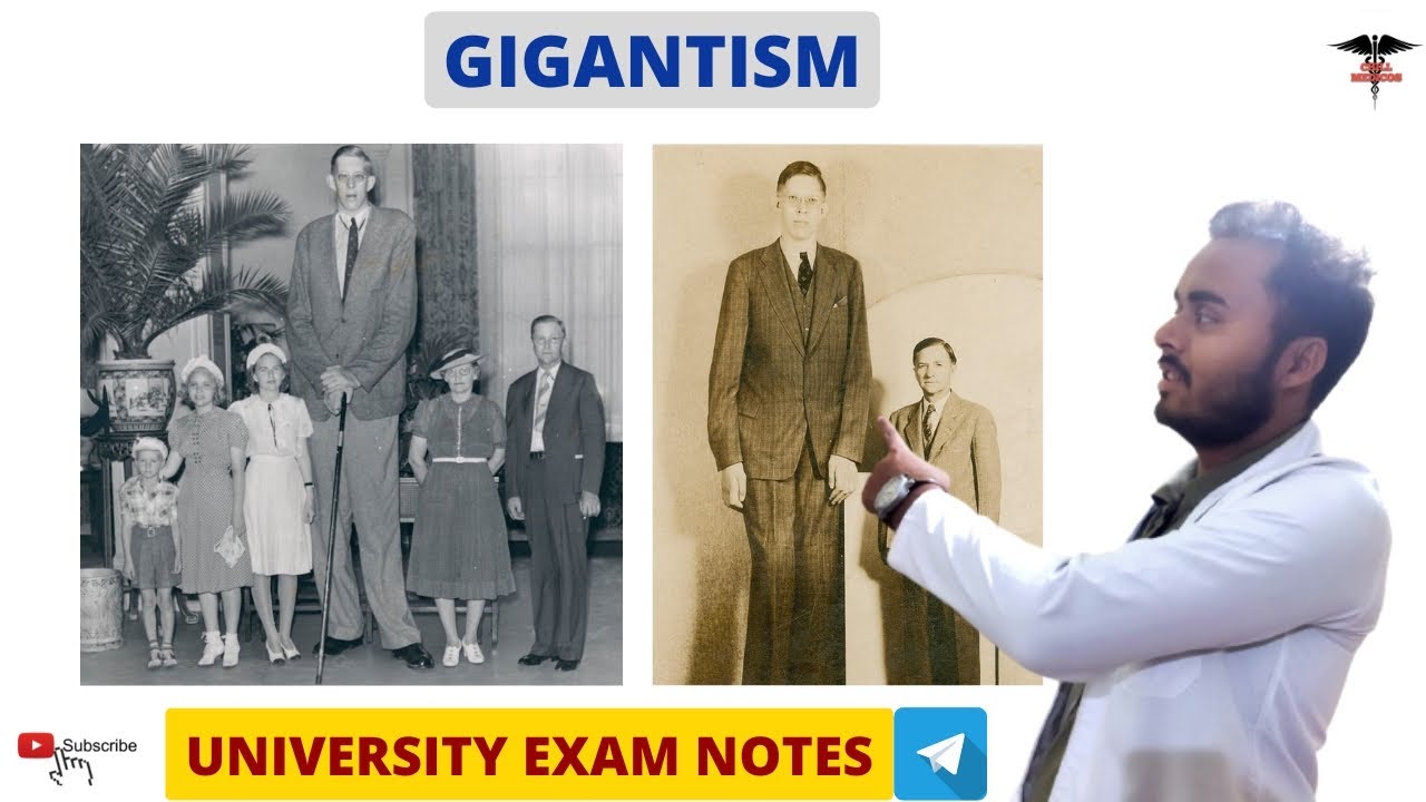 Gigantism || Cause || Signs & Symptoms || Endocrine Physiology - YouTube