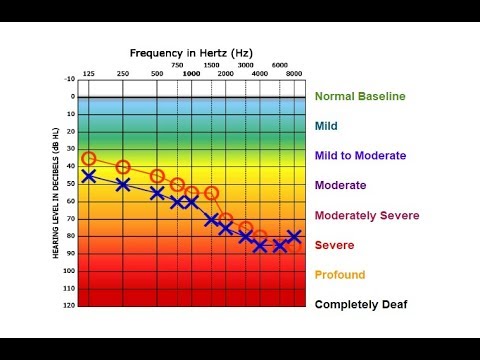 Audiogram Bone Conduction - YouTube