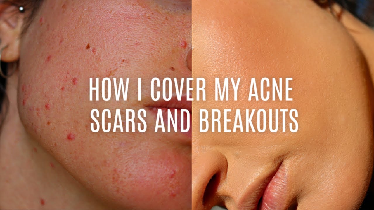 3 Makeup Hacks To Cover ACNE Scarring & Breakouts | Easy & Non-Cakey ...