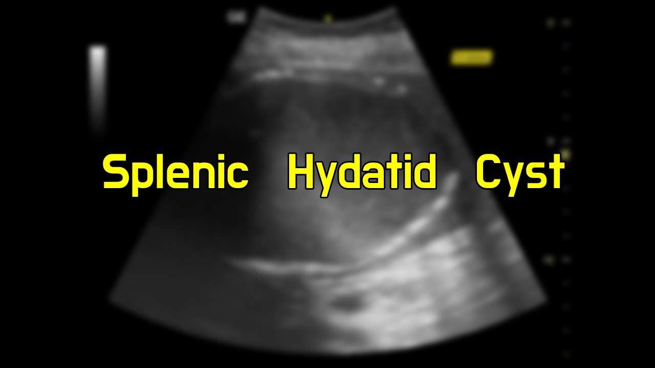 Splenic Hydatid Cyst - YouTube