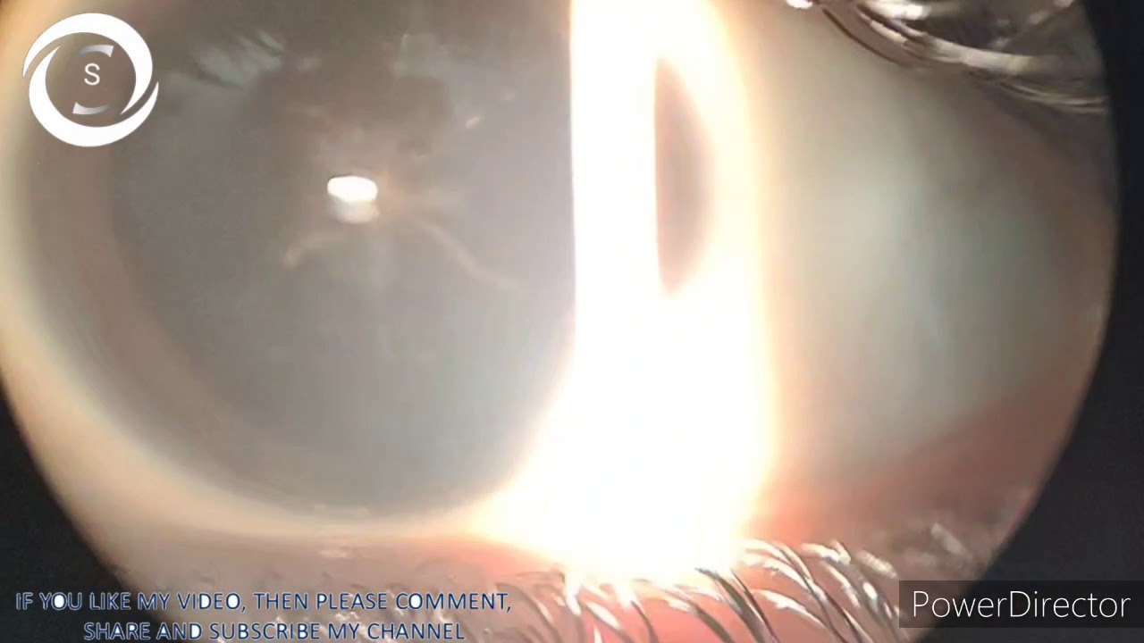 Congenital Sutural Cataract and biometry challenges - YouTube