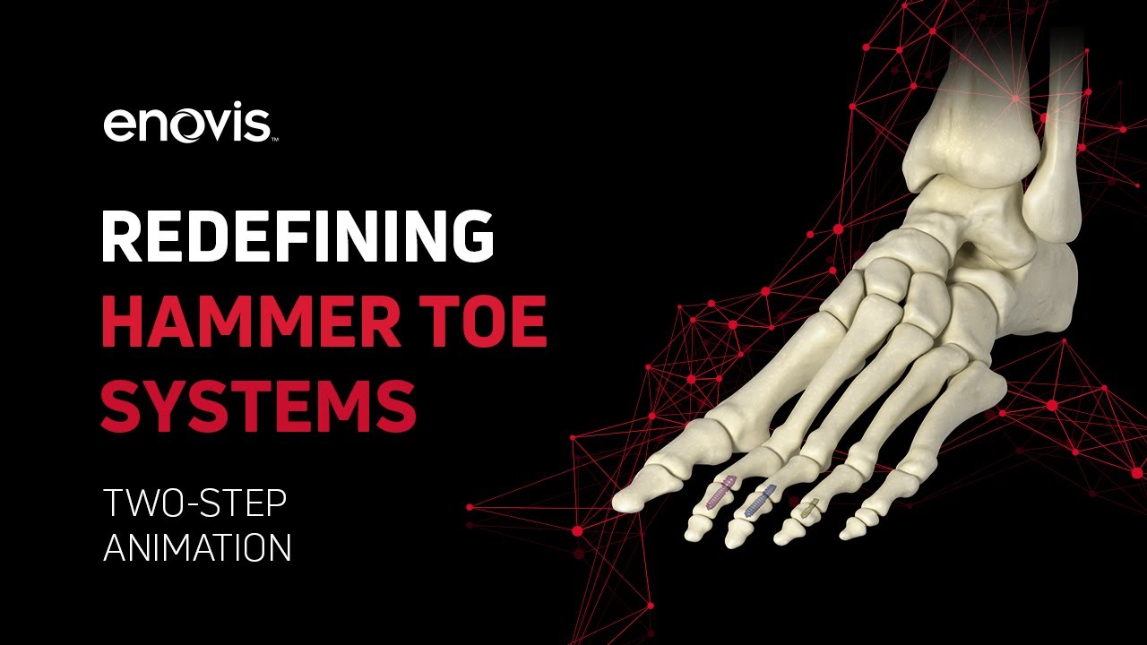 Two-Step Hammertoe Implant System Animation - YouTube