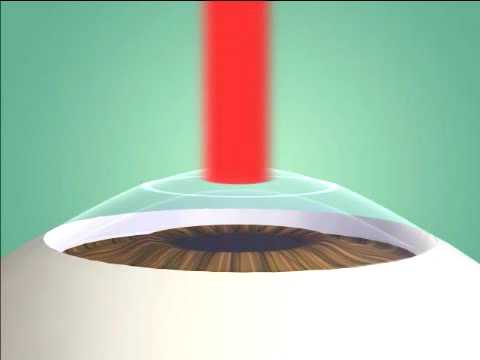 Steps of the PRK Procedure - YouTube