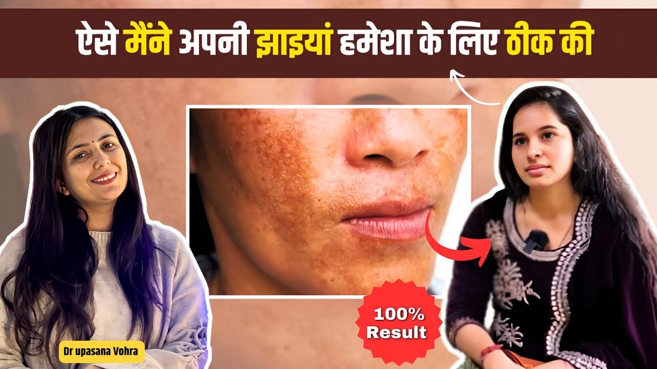 How to remove Pigmentation | Hyperpigmentation treatment Patient ...