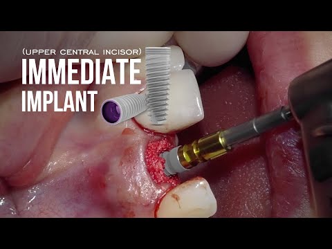 Immediate Implant (Upper Central Incisor) - YouTube
