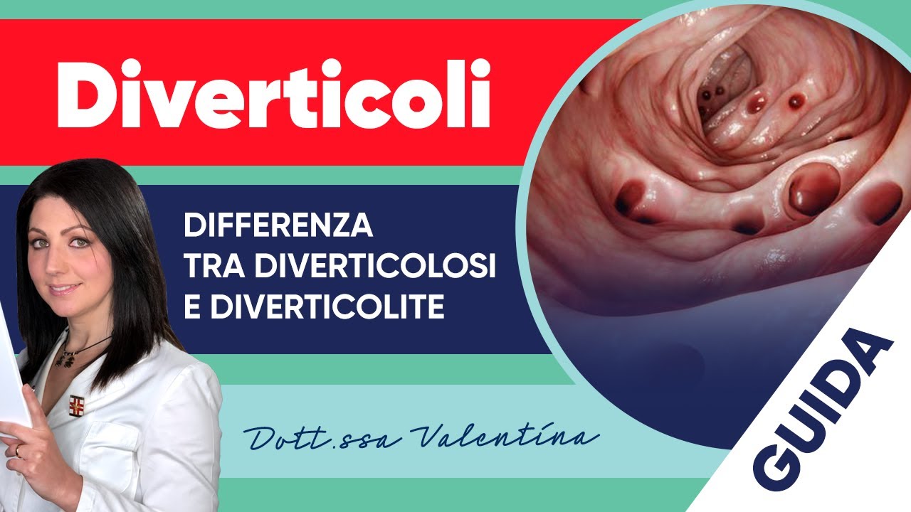 Diverticoli: cosa sono e qual è la differenza tra diverticolosi e ...