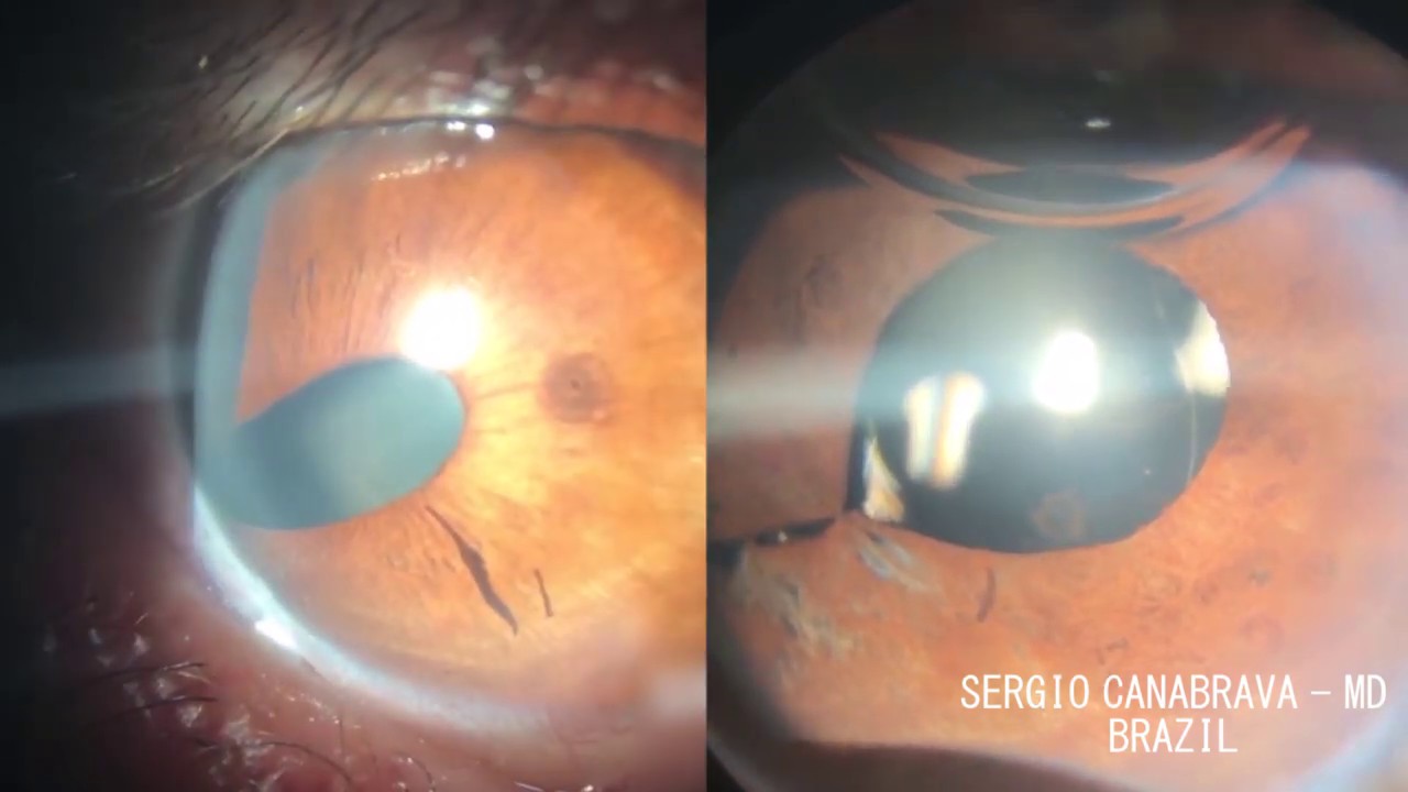 PUPILLOPLASTY WITH ENDOCAUTERY - YouTube