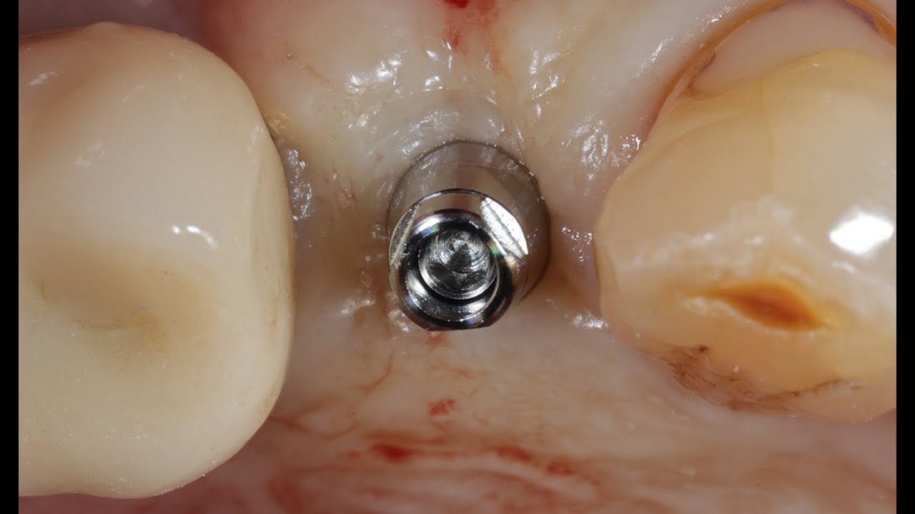 Early Loading with bright Implant - YouTube