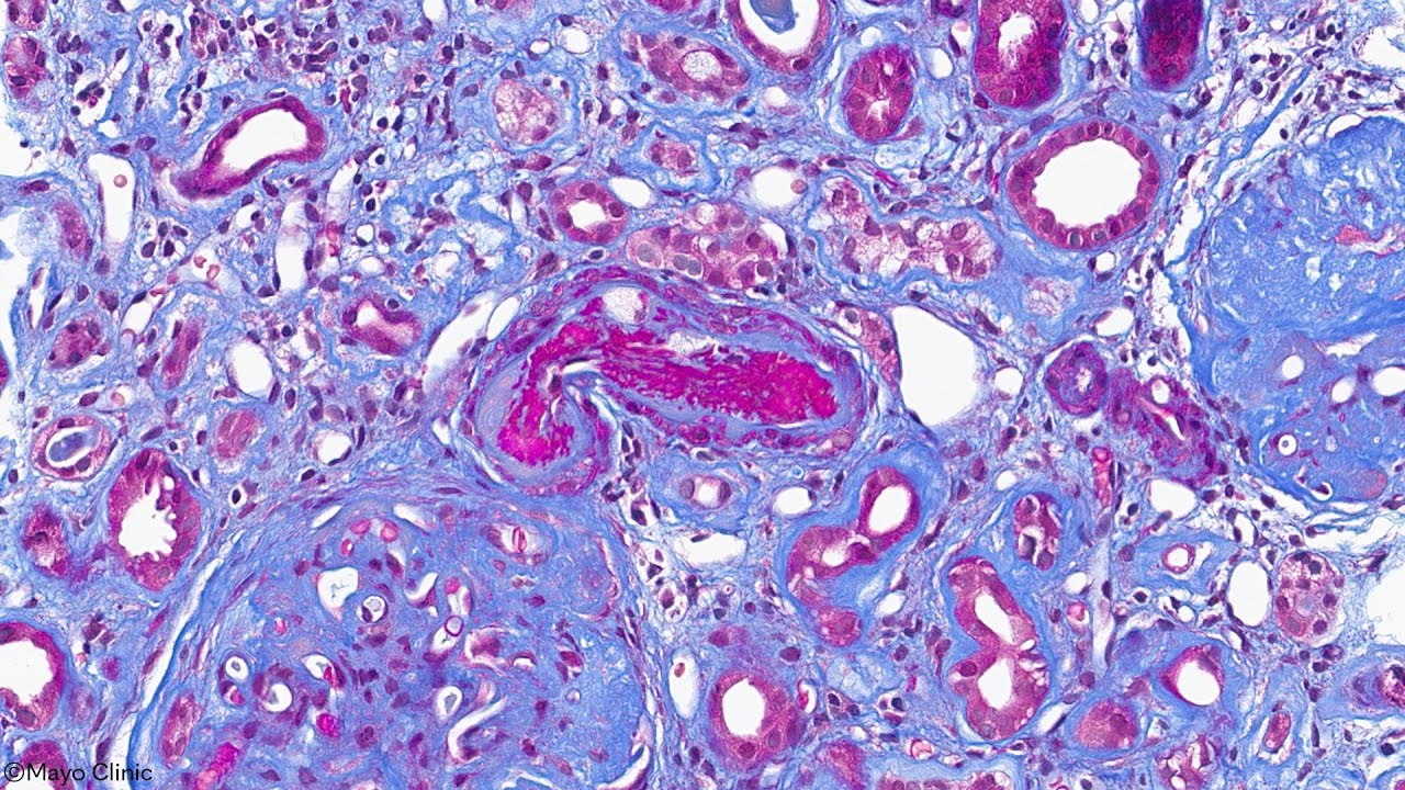 Complement Testing in the Diagnosis and Management of Thrombotic ...