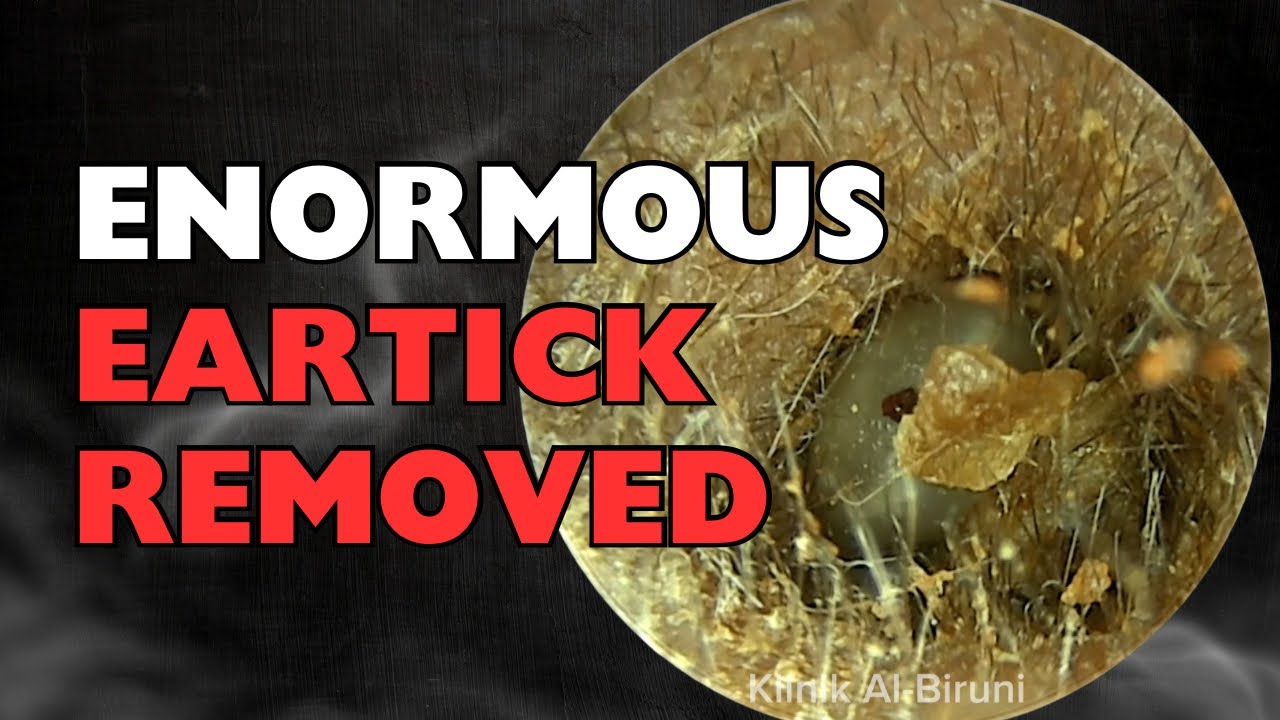 Enormous Fat Eartick Removed - YouTube