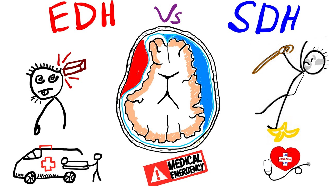 Extra dural,Epidural Hematoma Vs Subdural Hematoma for Usmle, Plab ...