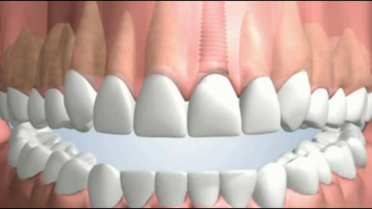 options for replacing a single missing tooth - YouTube
