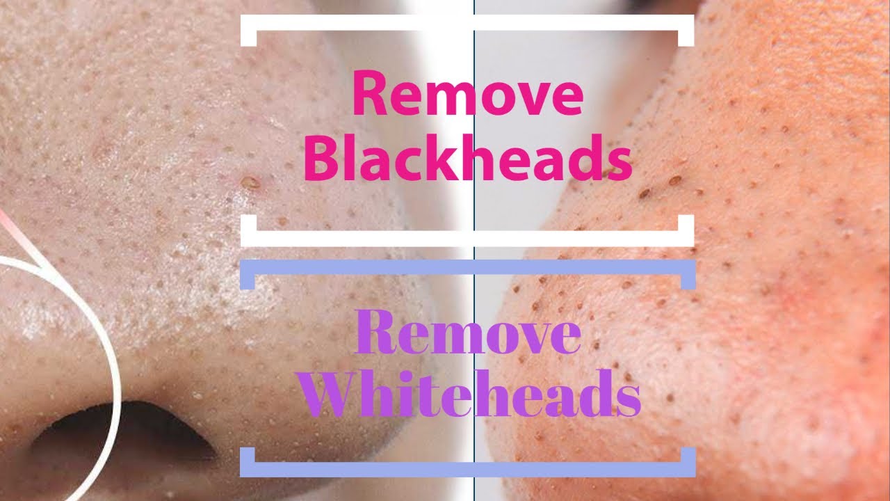 How to Remove Blackheads & Whiteheads Parmanently II Easy to Maintain ...