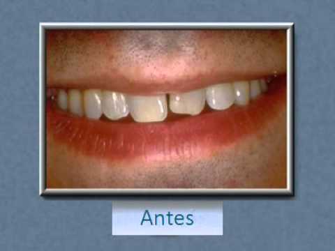 Usando carillas para alargar dientes cortos o desgastados - YouTube