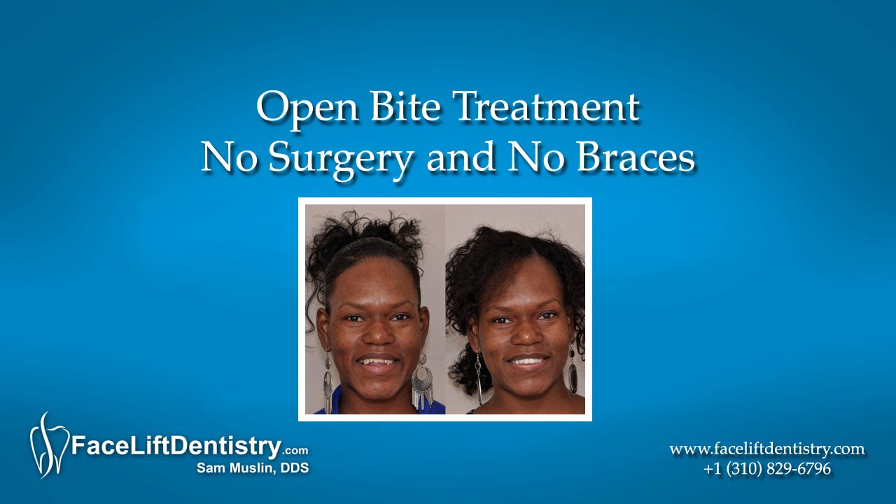 Open Bite Treatment - No Surgery and No Braces - YouTube