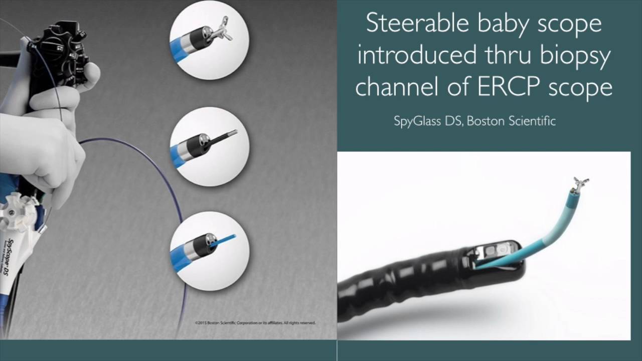 ERCP in Pregnancy - YouTube