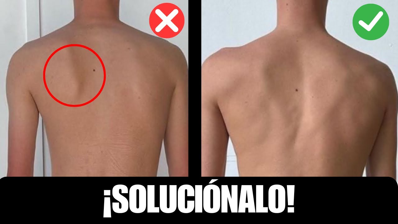 Corrige la escápula alada (Mejores ejercicios) - YouTube