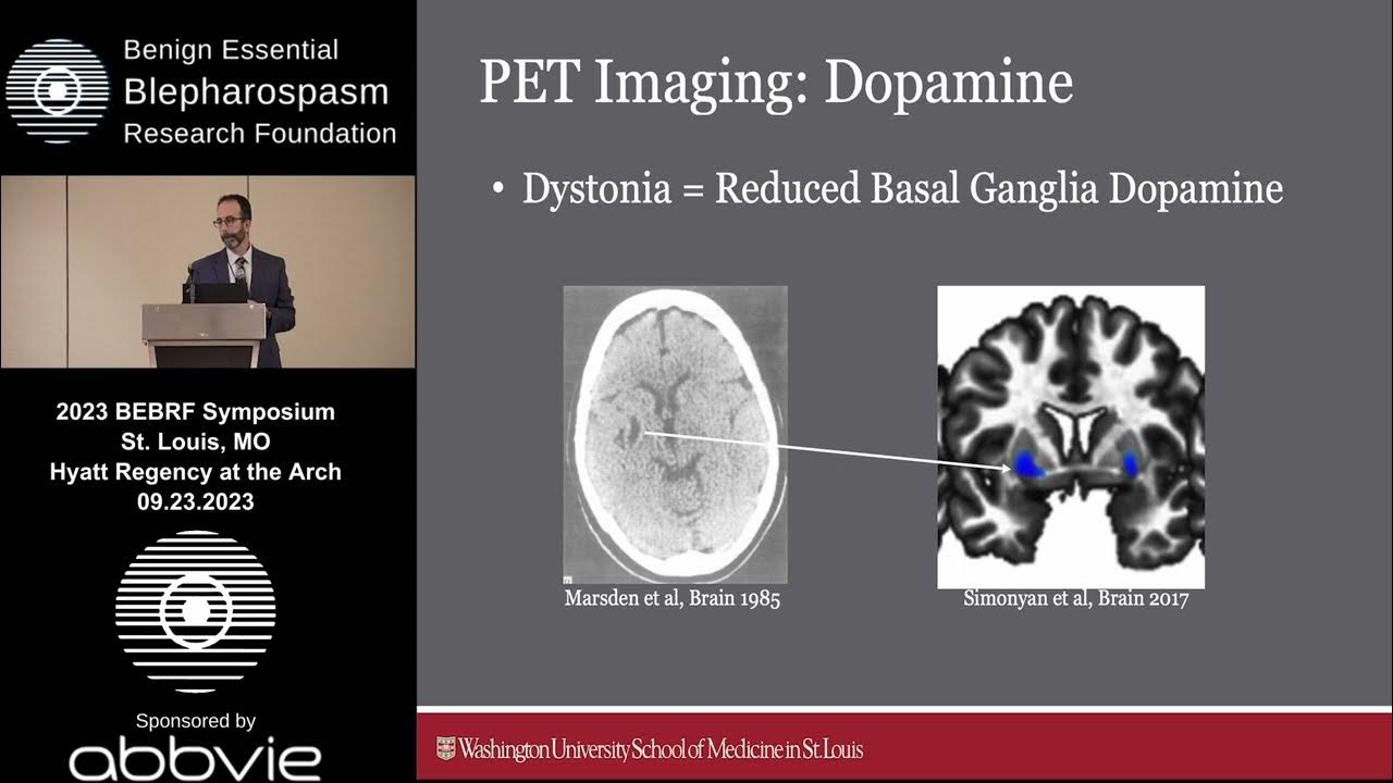 Multimodal Neuroimaging of Molecular & Brain Network Dysfunction in Dystonia - YouTube