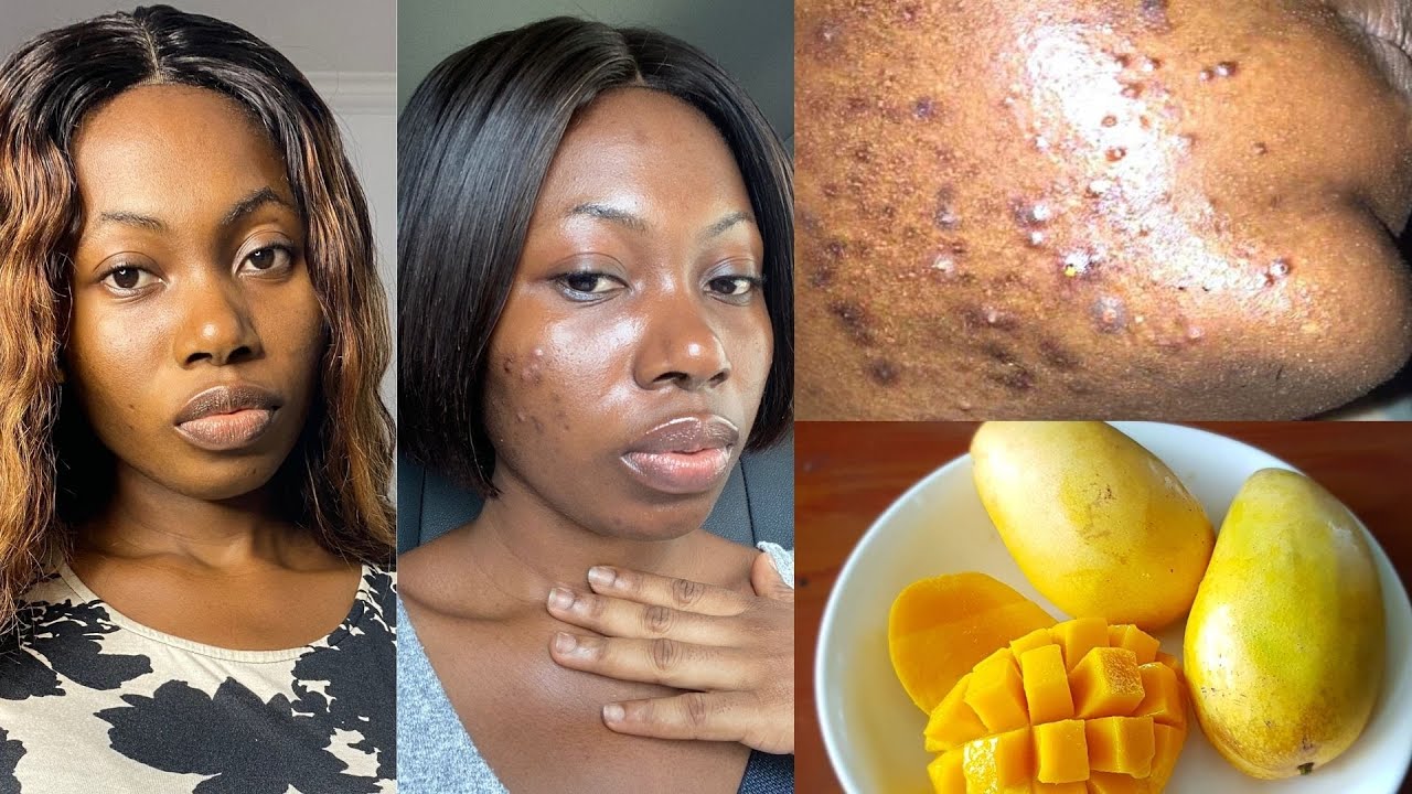 I USED MANGO ON MY FACE & THIS HAPPENED 7 DAYS AFTER - YouTube
