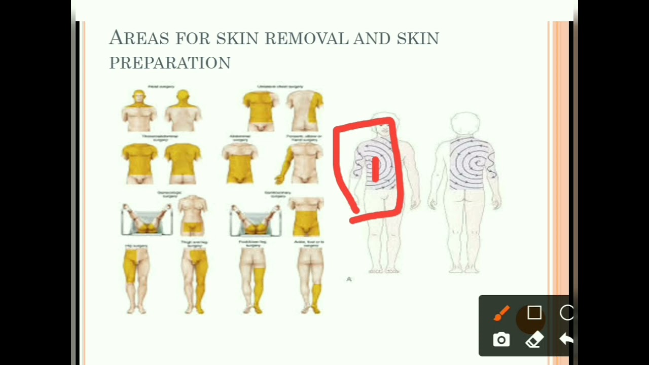 intraop complete - YouTube