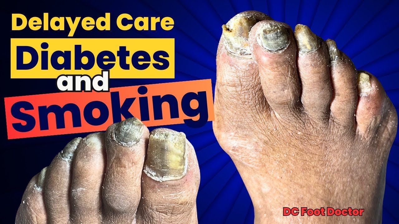 Delayed Care, Diabetes, and Smoking: Treating Thick, Fungal Toenails ...