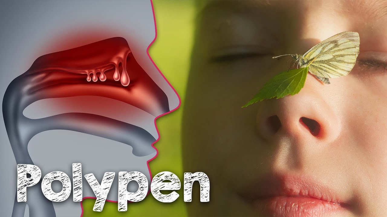 Nasenpolypen - adenoide Wucherungen - So werden sie natürlich ...