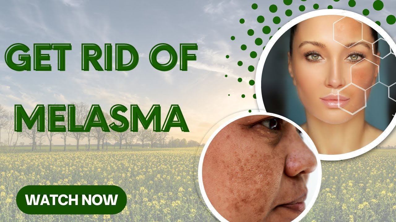Get rid of Melasma with home care|| Dr. Neha Dongaonkar - YouTube