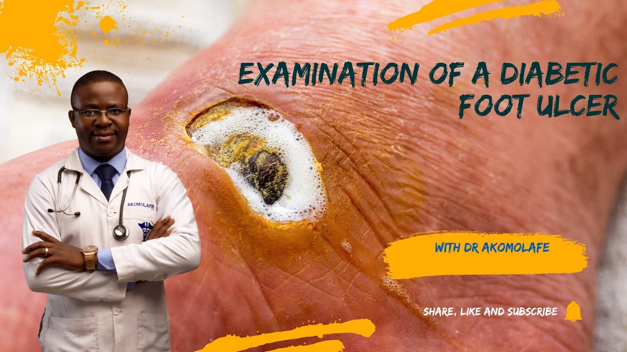 examination of a diabetic foot ulcer - YouTube