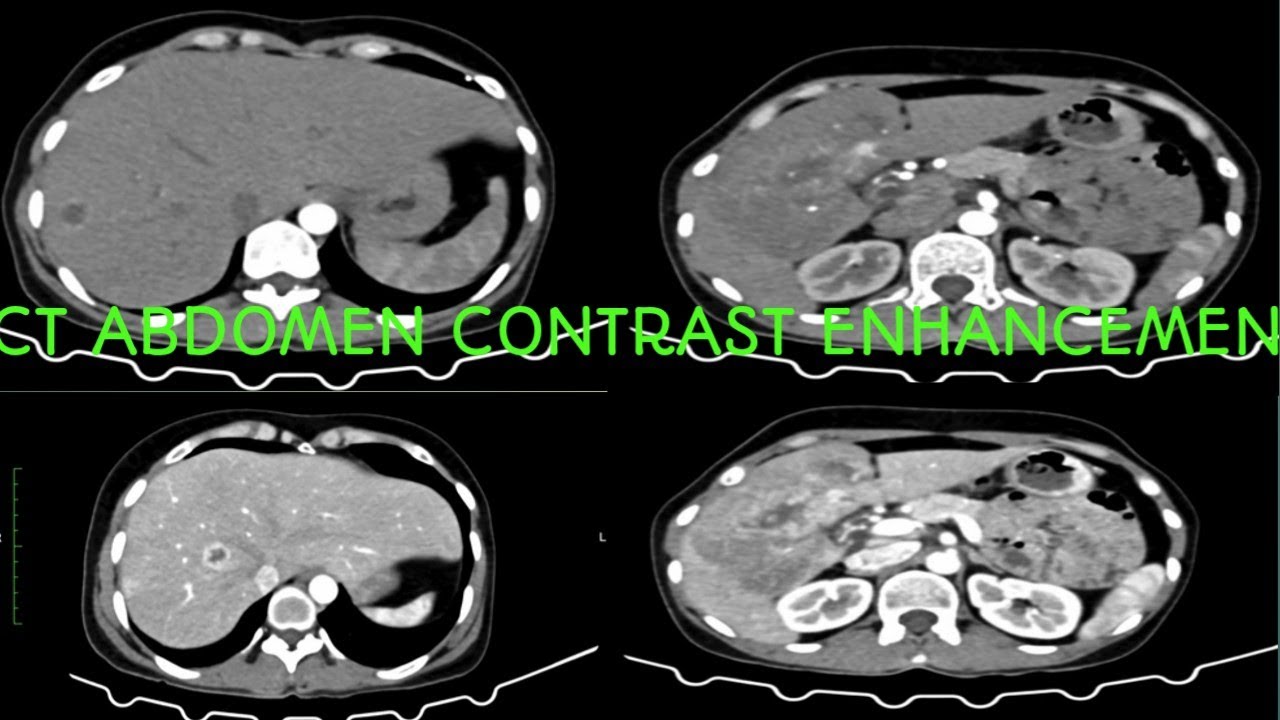 Ct abdomen triple phase contrast enhancement ct abdomen contrastct ...