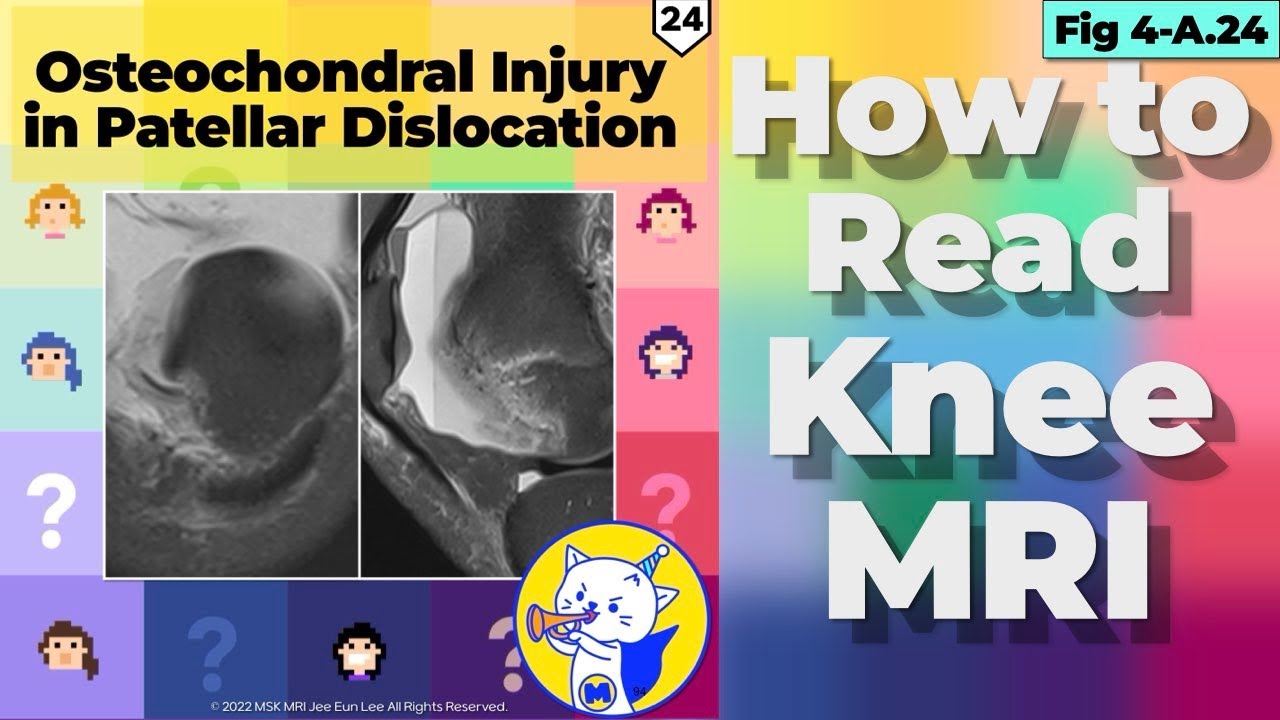 (Fig 4-A.24) Osteochondral Injury in Patellar Dislocation - YouTube