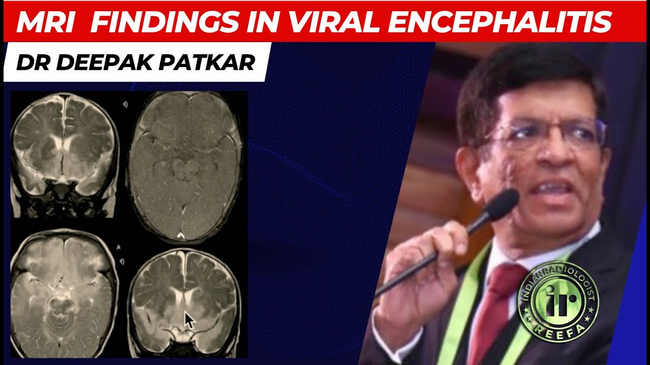 DR DEEPAK PATKAR || CNS INFECTIONS - Viral Encephalitis - YouTube