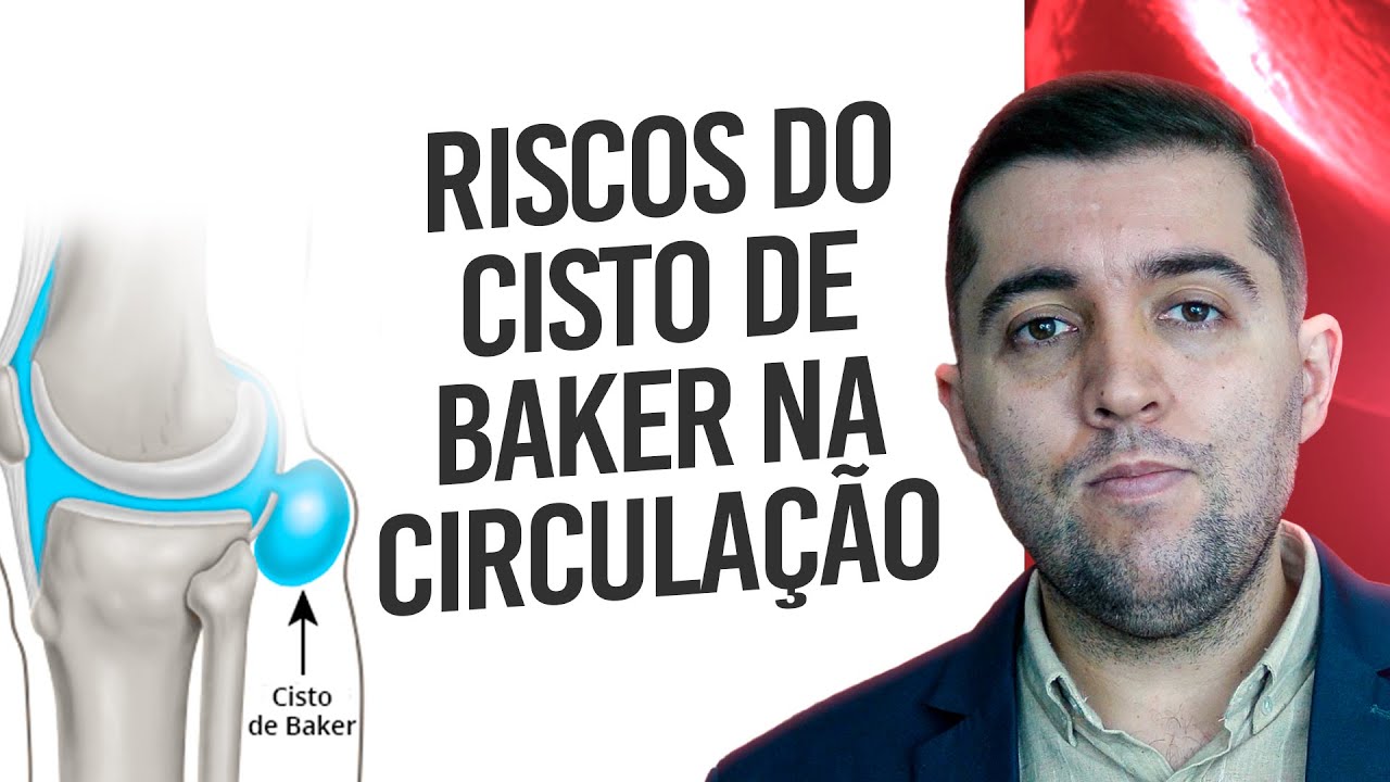 Cisto de baker, dor nas pernas e má circulação: como identificar, quais ...