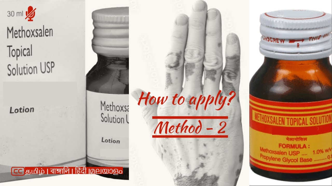 How to apply Methoxsalen topical solution in vitiligo? - Method 2 ...
