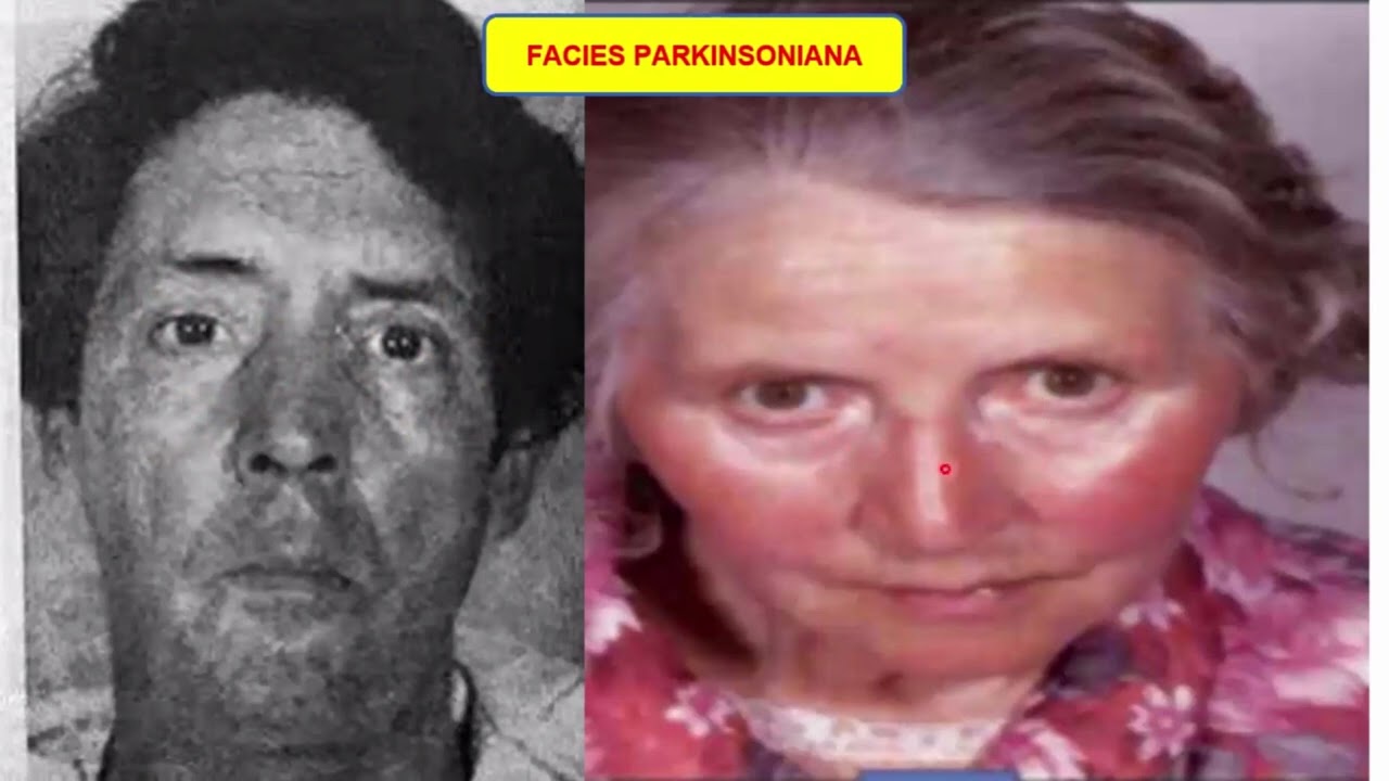 Facies Parkinsoniana