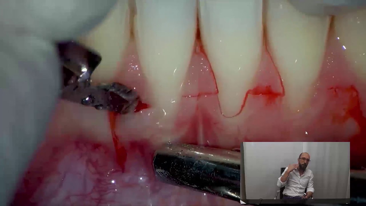 Mucogingival surgery for recession treatment - trailer - YouTube