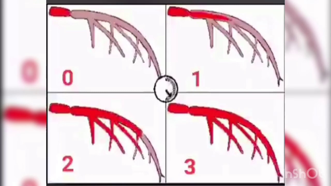 TIMI flow grading system - Coronary Intervention - PCI AHA - YouTube
