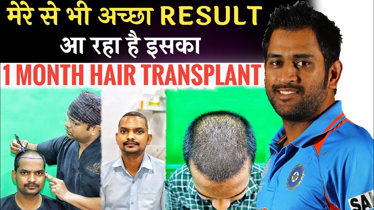 "Transformed in 30 Days: My Amazing Hair Transplant Journey" | Hairline ...