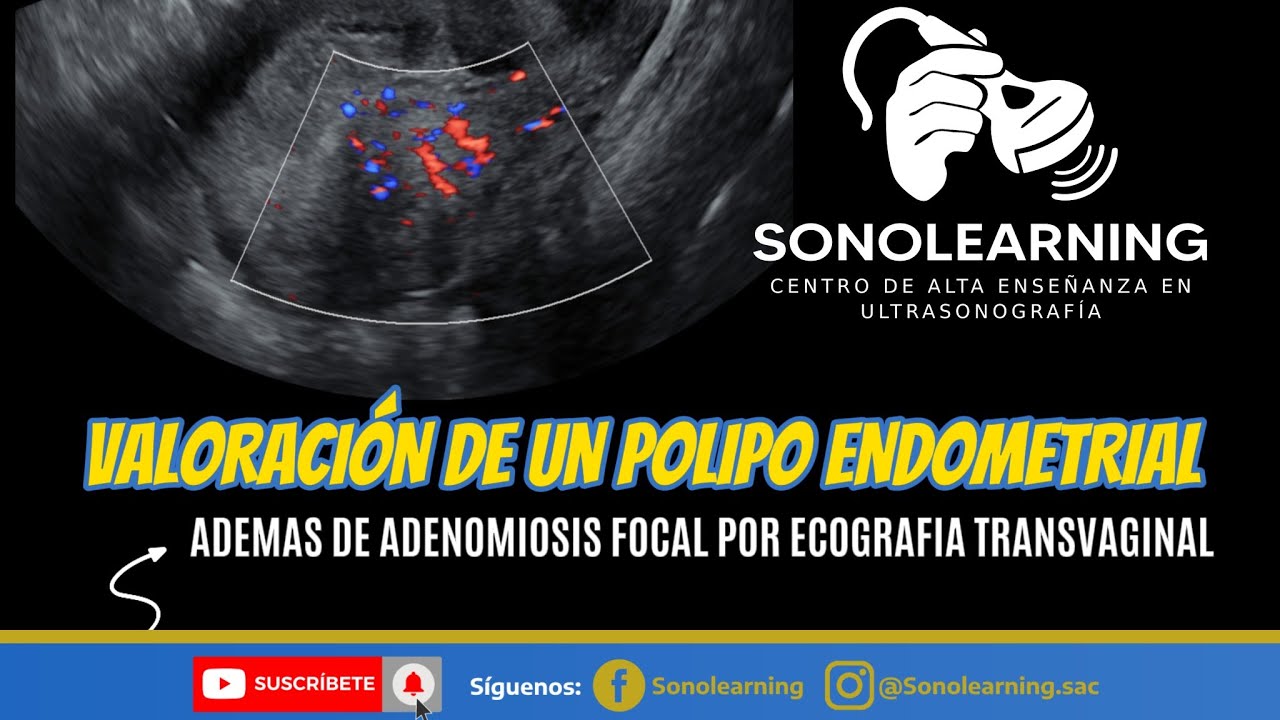 VALORACION DE UN POLIPO ENDOMETRIAL ADEMAS DE ADENOMIOSIS FOCAL POR ...
