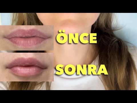 EN DOĞAL DUDAK DOLGUSU! | İşlem görüntüleriyle