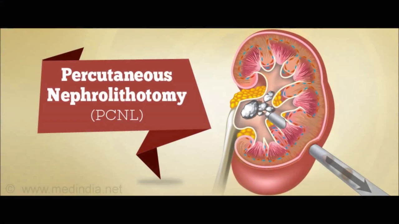 Kidney Stone Removal Percutaneous Nephrolithotomy PCNL YouTube