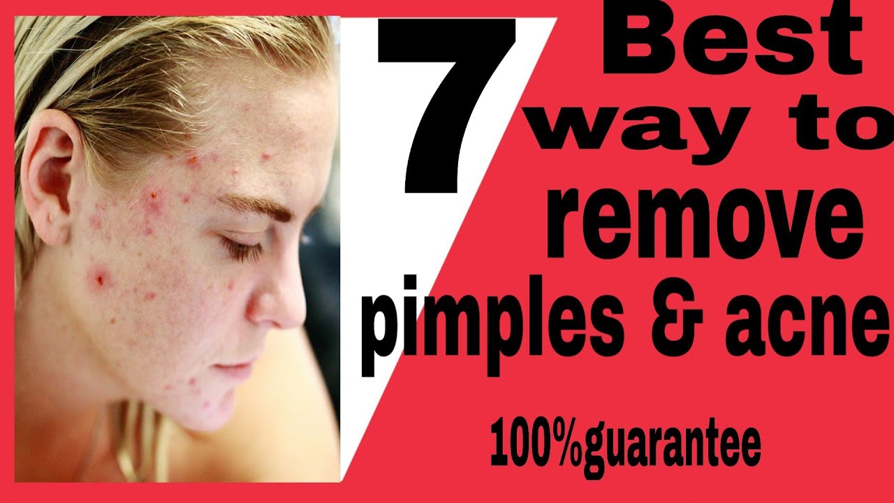 How To Get Rid of a Pimple & Acne |7 ways to remove pimples| Homemade ...