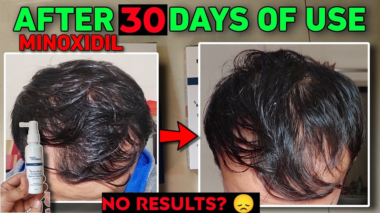 The LONG TERM Effects of Minoxidil You Need to Know | Results and My ...