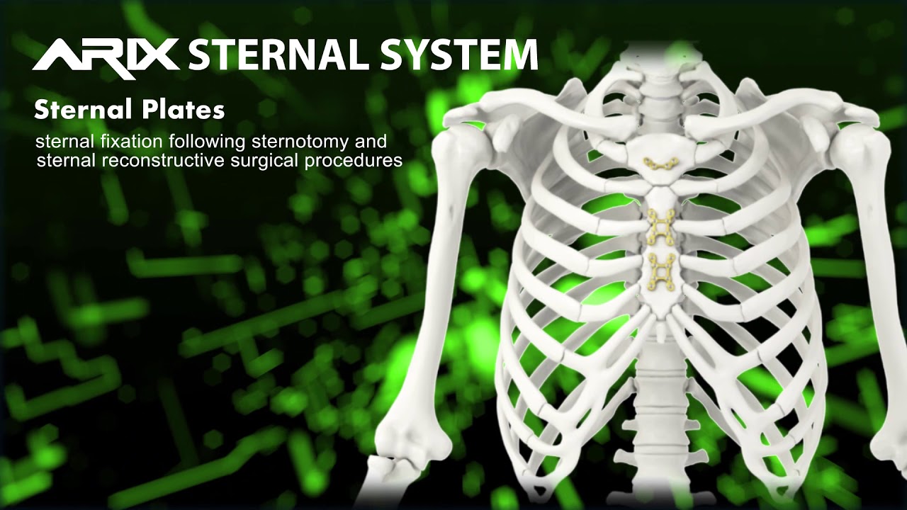 [ARIX CS] ARIX Sternal System - YouTube