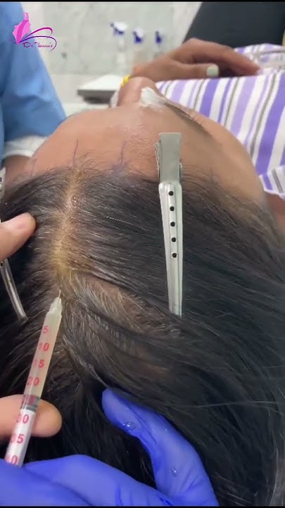 Gfc Hair Loss Hair Growth Hair Treatment Tannu Skin Clinic