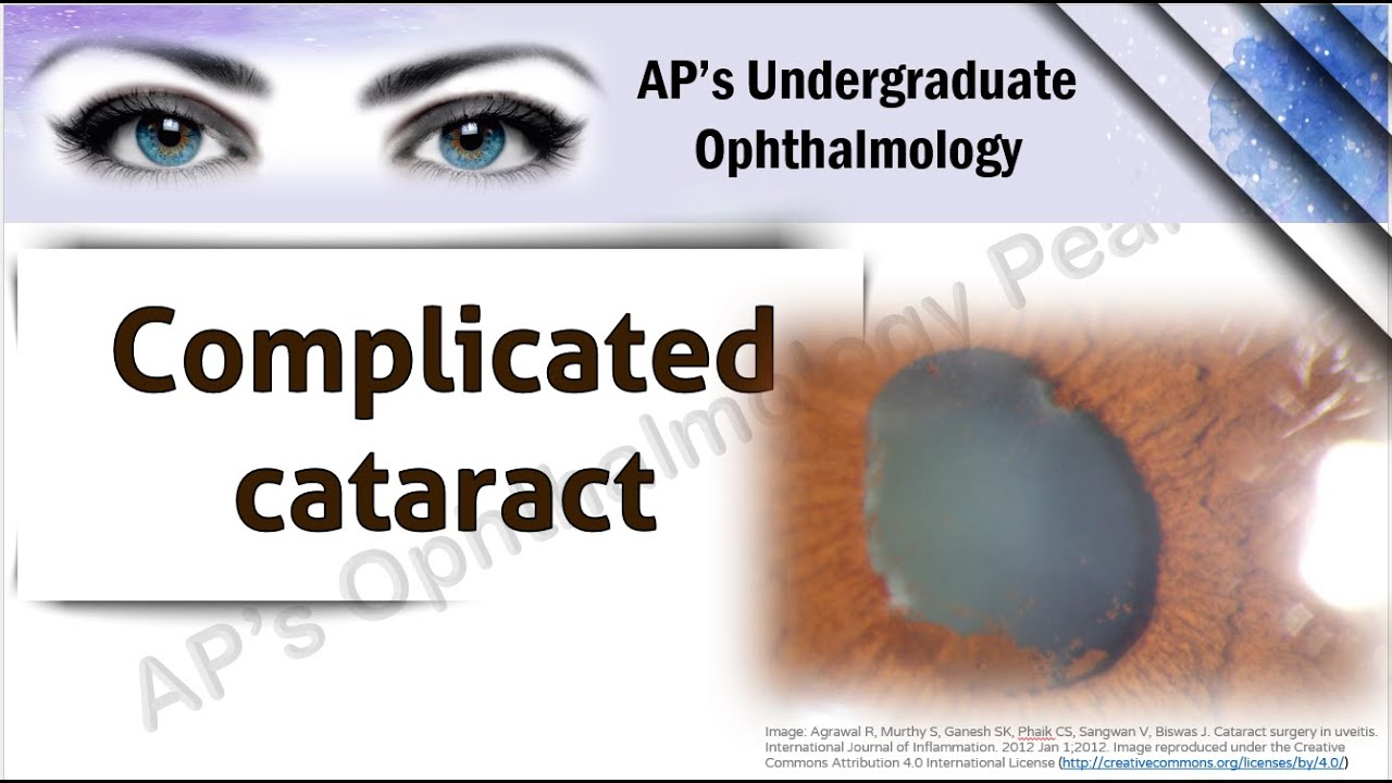 Complicated cataract | AP'S Undergraduate Ophthalmology - YouTube